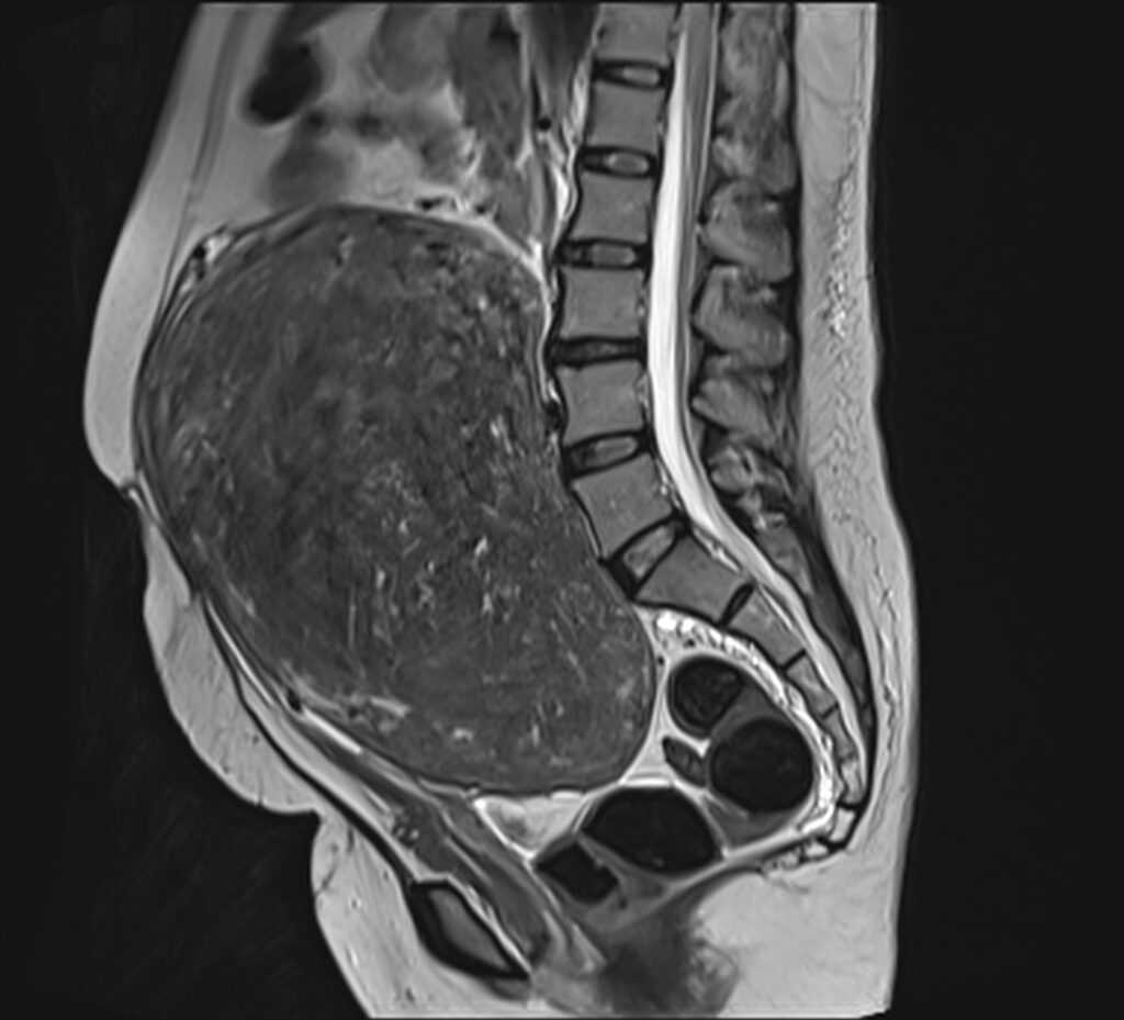 Can Fibroids Cause Pain in Lower Back? Understanding the Connection