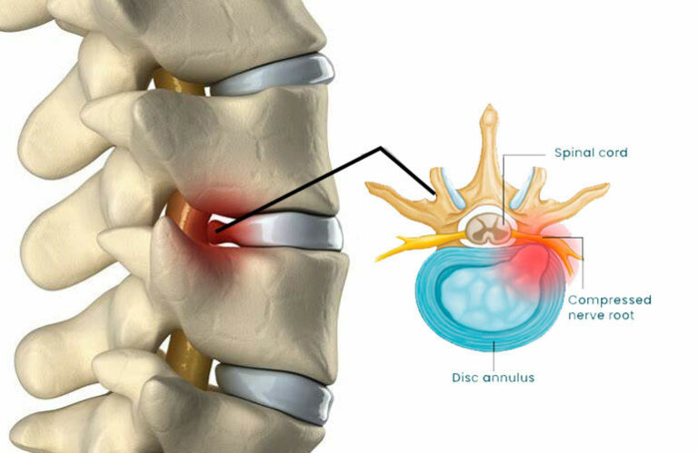 Does Hernia Cause Back Pain? Understanding the Connection and Treatment ...